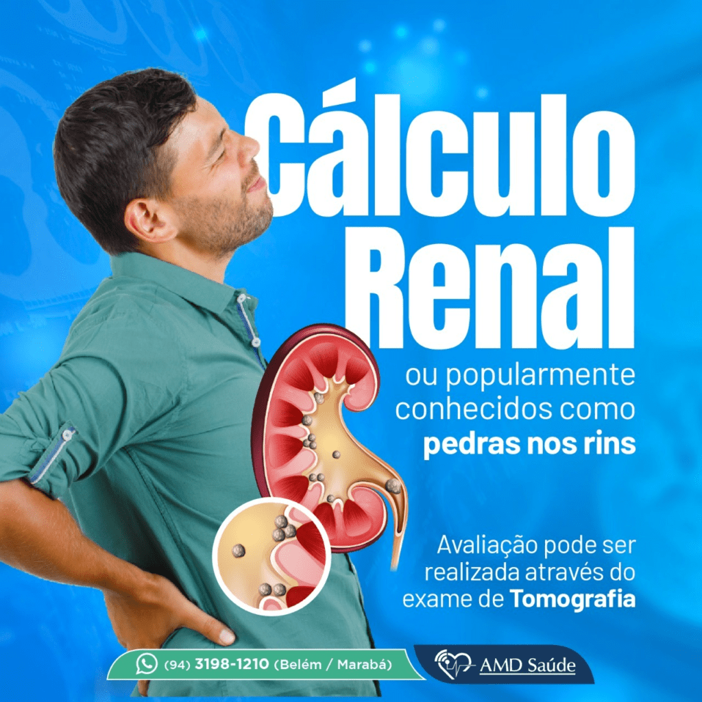 Cálculo Renal • AMD Saúde
