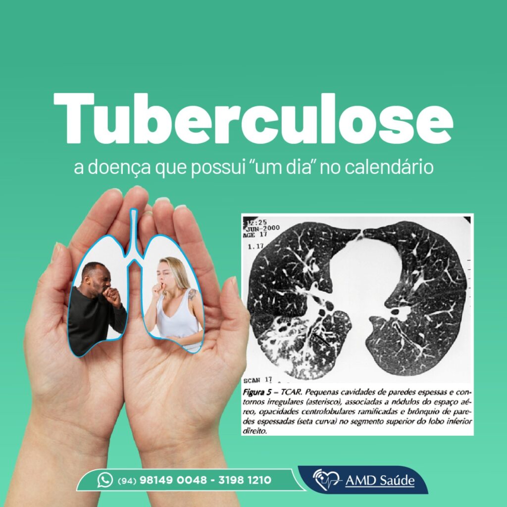 Tuberculose: Tudo que você precisa saber • AMD Saúde